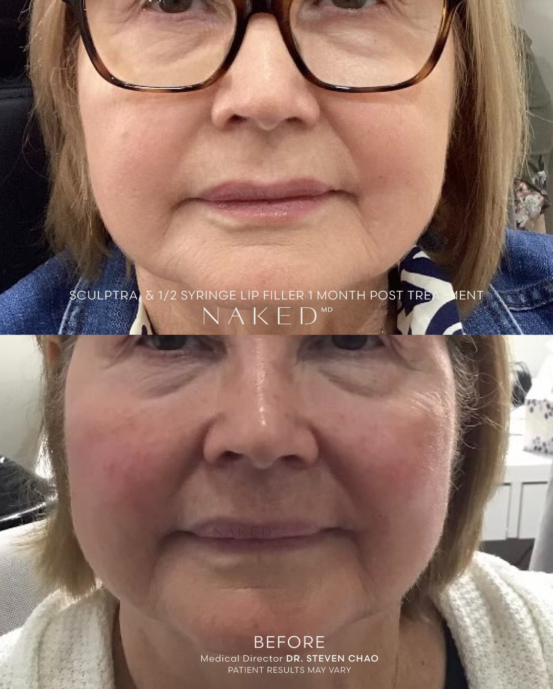 Sculptra® Filler & Injections for Natural Facial Volume – NAKEDMD Medspa