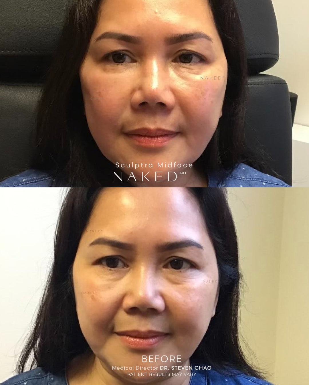 Sculptra® Filler & Injections for Natural Facial Volume – NAKEDMD Medspa