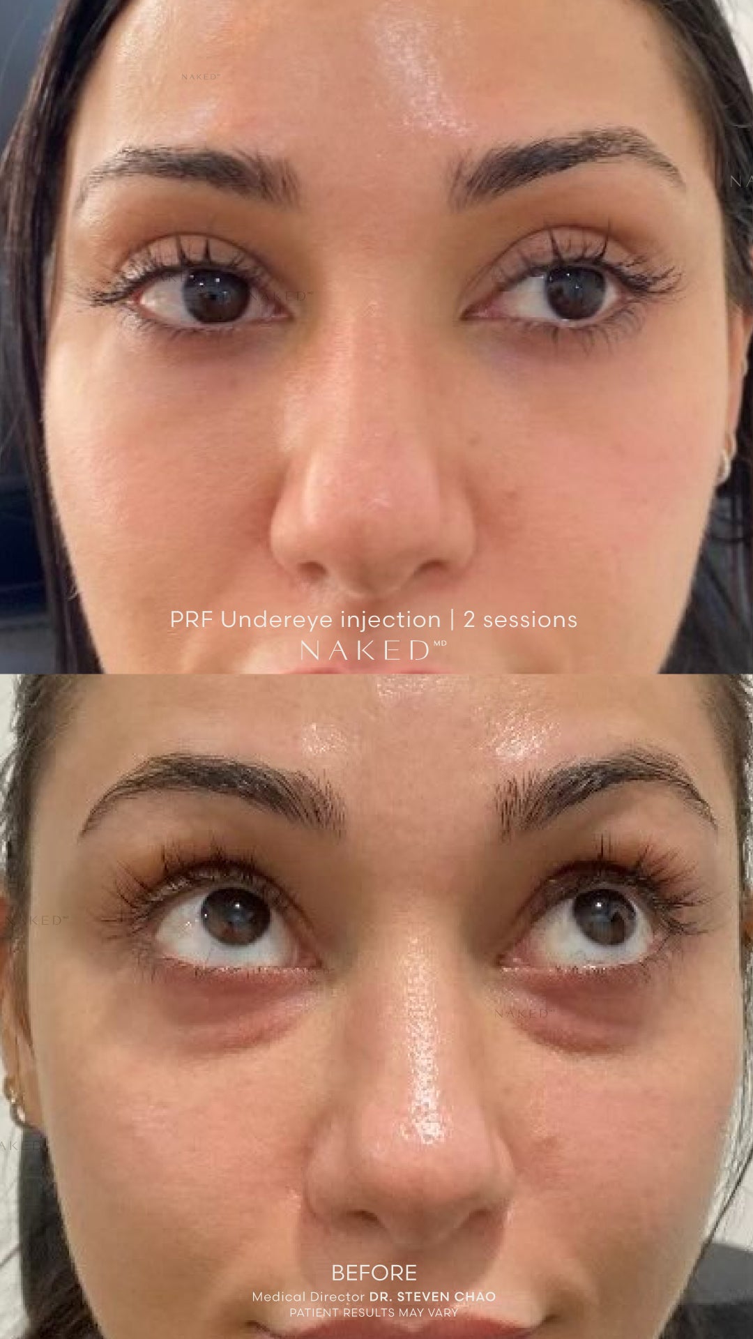 PRF (Platelet Rich Fibrin) Injection – NAKEDMD Medspa