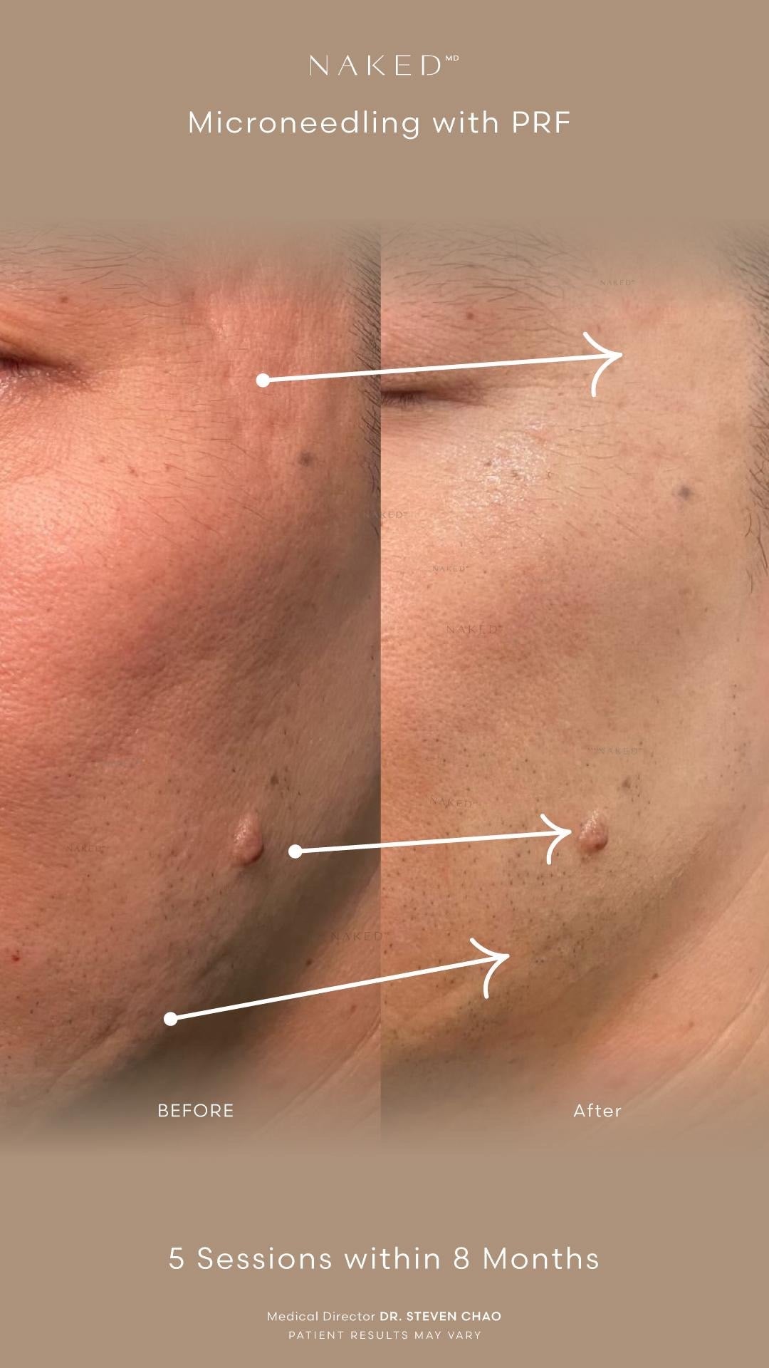 Vampire Facial | PRF Microneedling for Youthful Skin – NAKEDMD Medspa