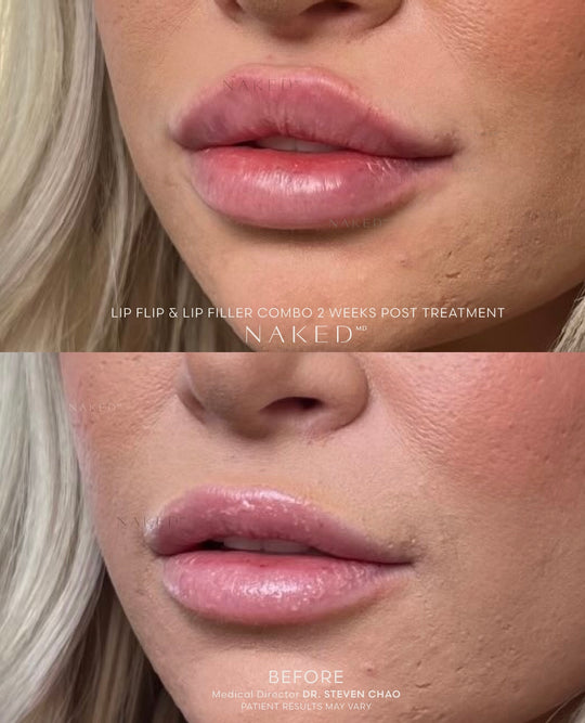 Lip Flip | TOX Lip Flip for Natural Lip Enhancement – NAKEDMD Medspa