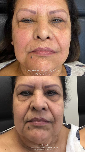 Sculptra® Filler & Injections in California and Arizona – NAKEDMD Medspa