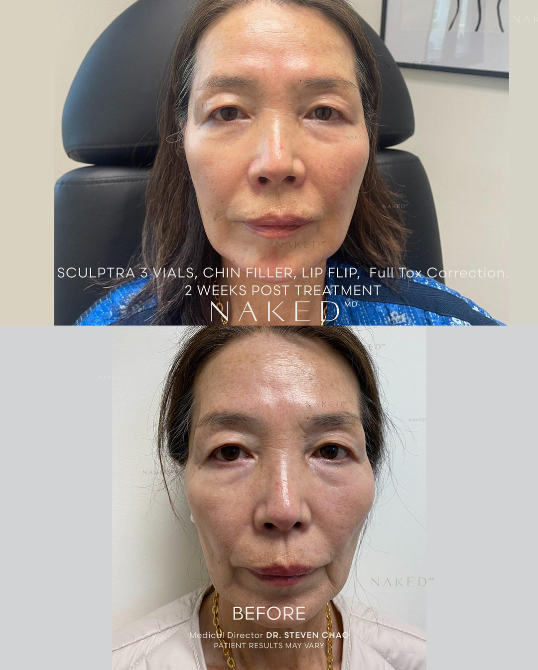 Sculptra® Filler & Injections in California and Arizona – NAKEDMD Medspa