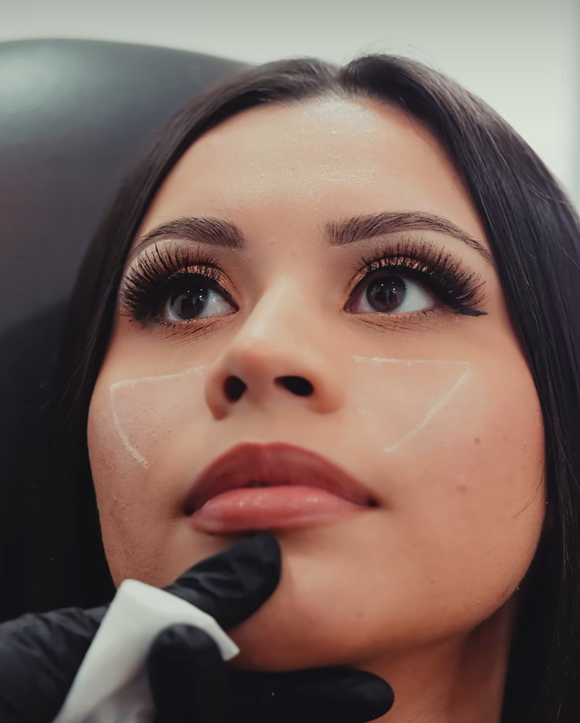 Cheek Filler | Cheek Dermal Treatment in California & Arizona – NAKEDMD ...