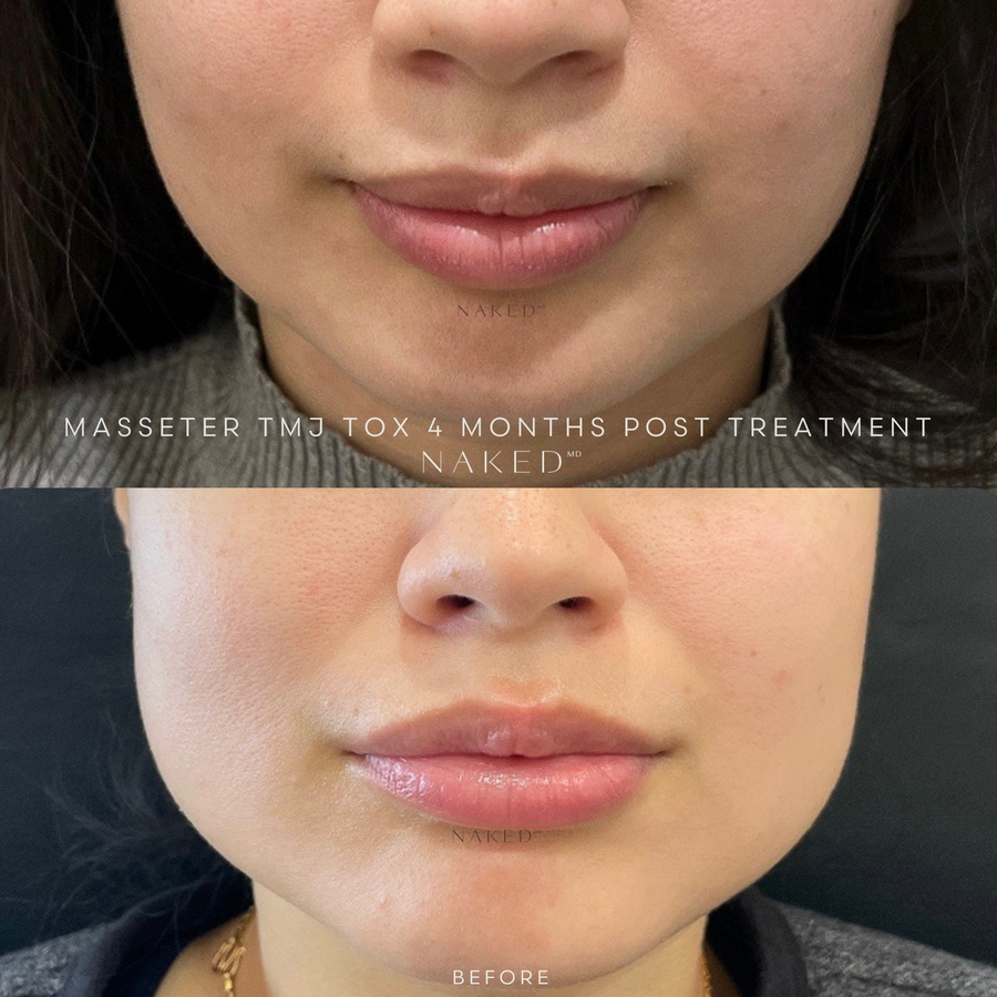 Masseter TOX Treatment & Reduction for a Sleek Jawline – NAKEDMD Medspa