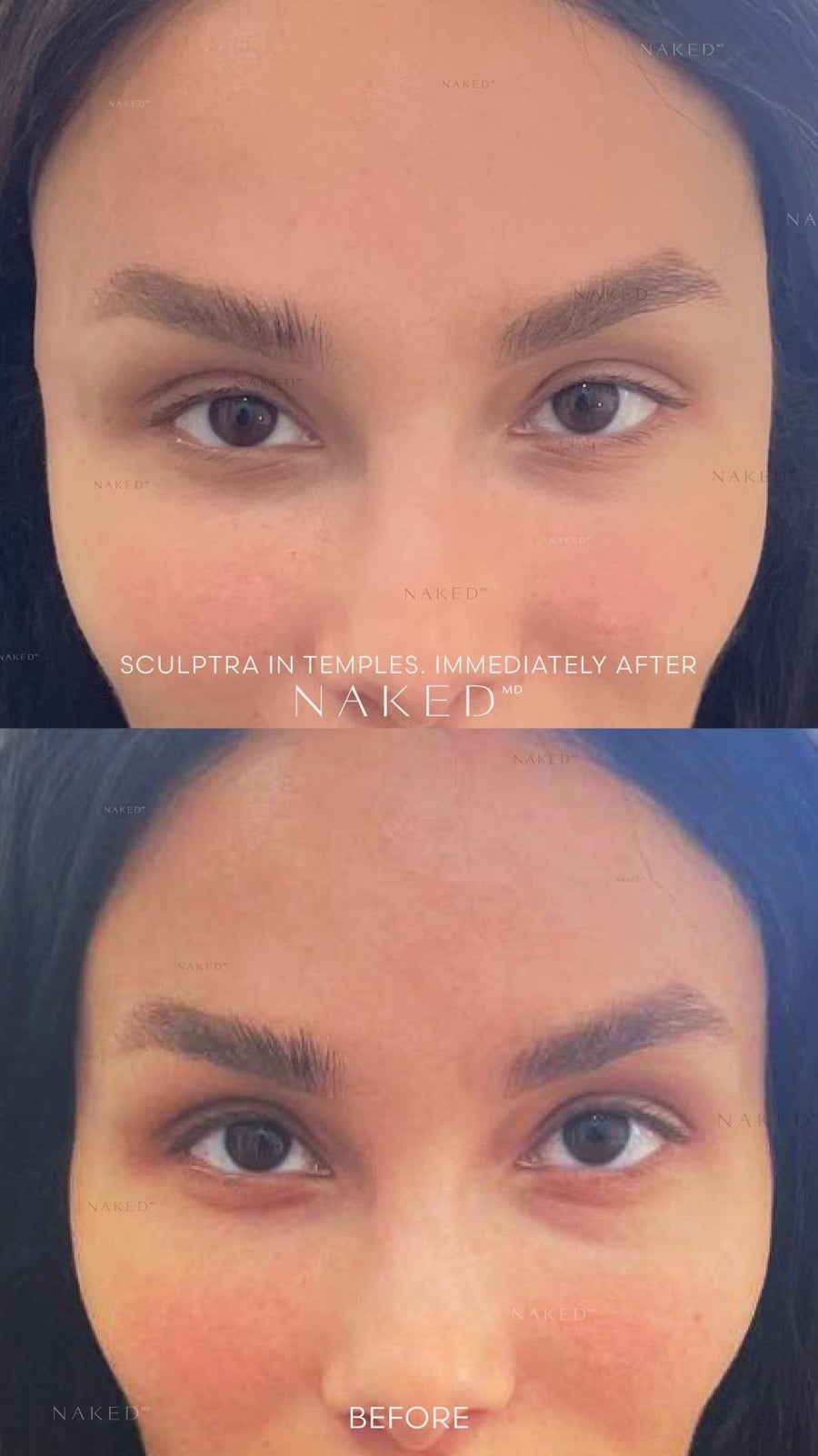 Sculptra® Filler & Injections in California and Arizona – NAKEDMD Medspa