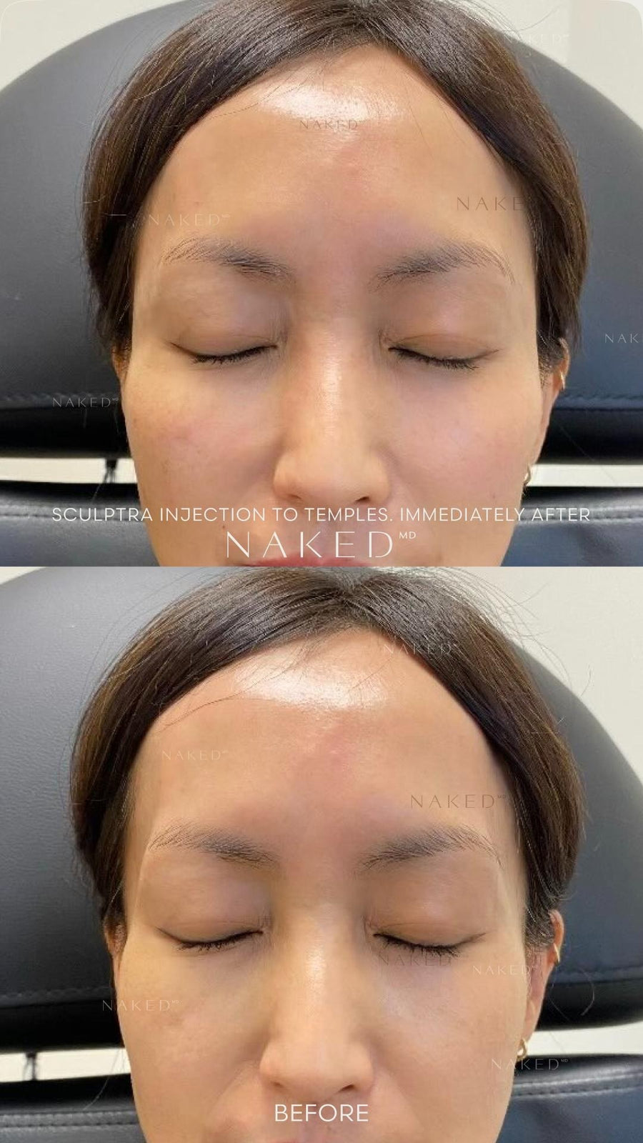 Sculptra® Filler & Injections for Natural Facial Volume – NAKEDMD Medspa