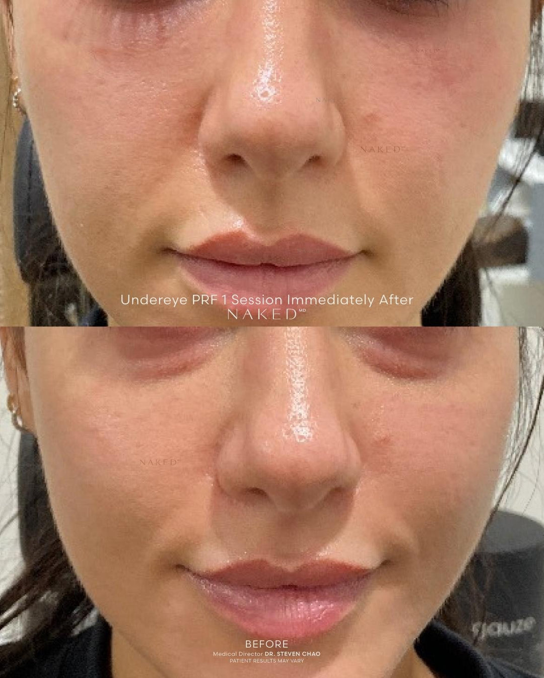 PRF (Platelet Rich Fibrin) Injection – NAKEDMD Medspa