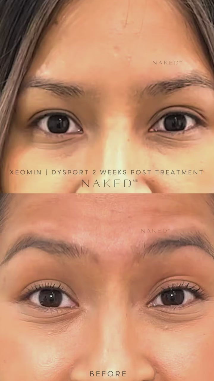 Naked Tox | Neurotoxins – NAKEDMD Medspa