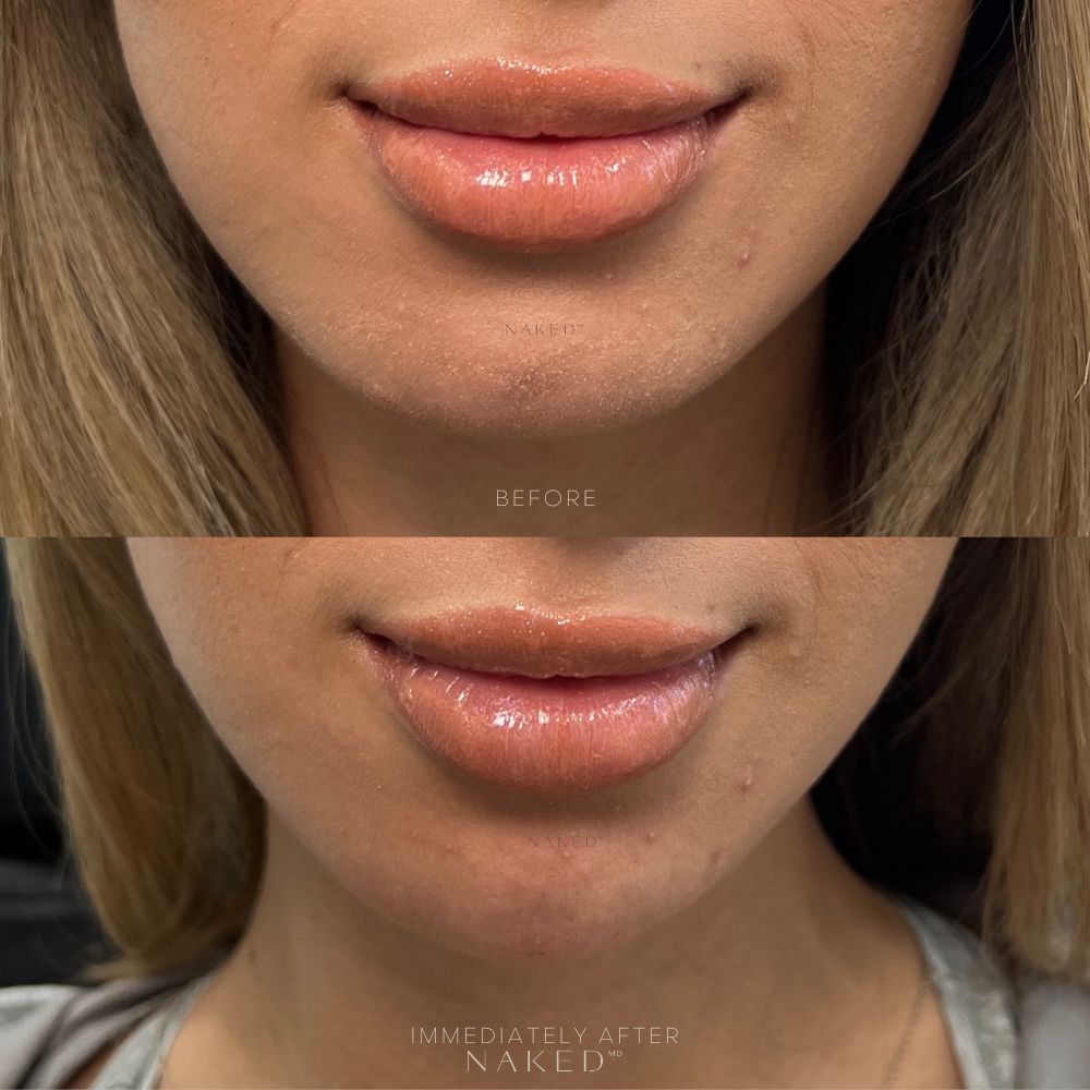 Chin Filler Nakedmd Medspa