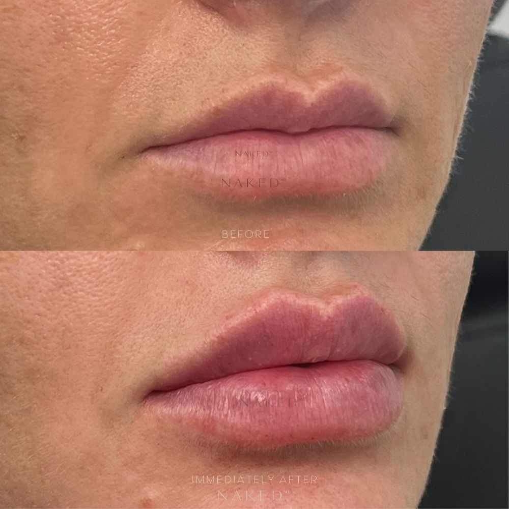 Lip Filler Lip Injections In California And Arizona Nakedmd Medspa