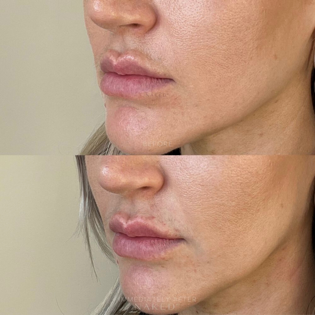 Hylenex | Hyaluronidase Injection for Safe Filler Dissolving – NAKEDMD ...