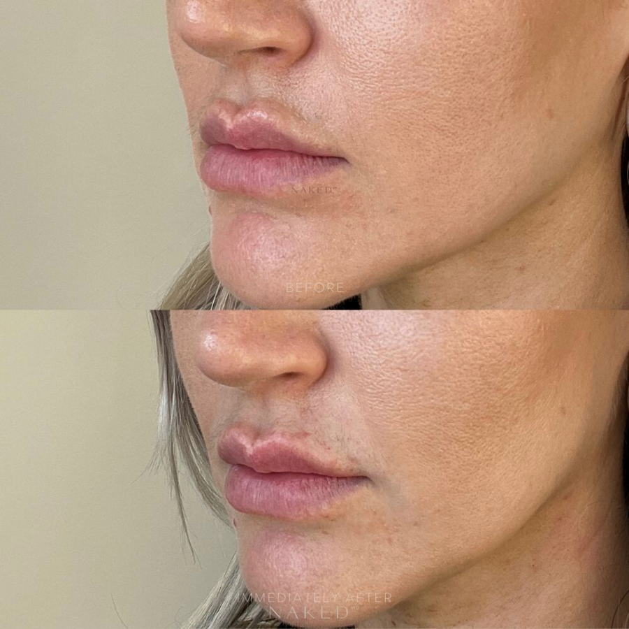 Hylenex | Hyaluronidase Injection for Safe Filler Dissolving – NAKEDMD ...