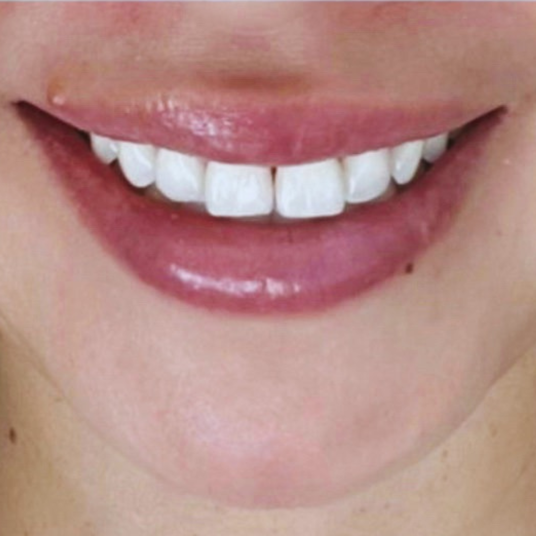 Correct a Gummy Smile with Expert TOX Treatment – NAKEDMD Medspa