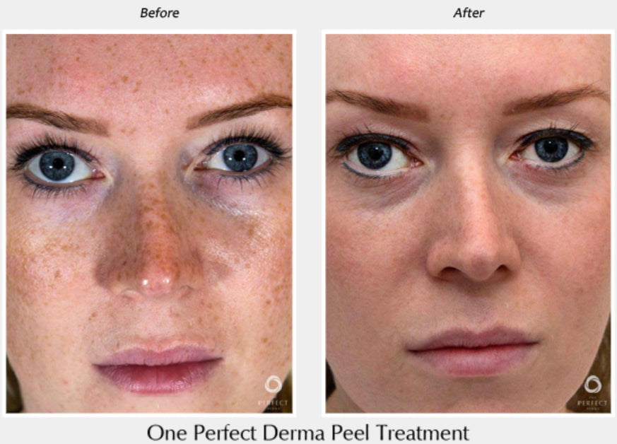 Perfect Derma Peel® for Clearer, Healthier Looking Skin – NAKEDMD Medspa