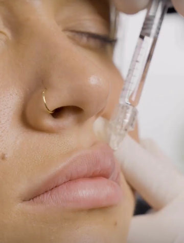 Hylenex | Hyaluronidase Injection for Safe Filler Dissolving – NAKEDMD ...