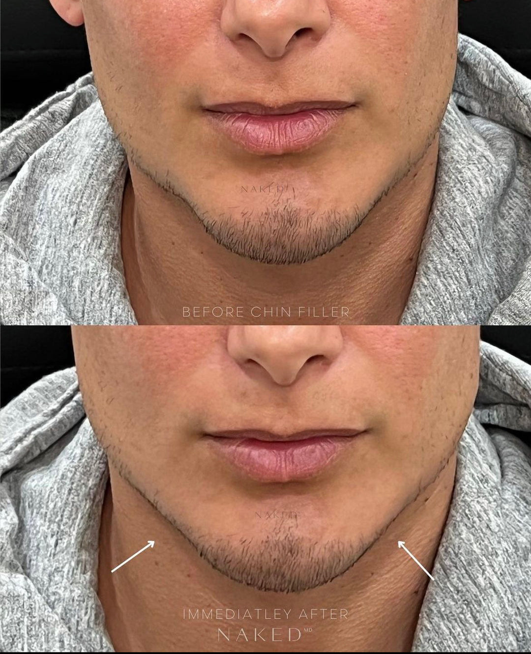 Best Chin Dermal Filler in California & Arizona – NAKEDMD Medspa