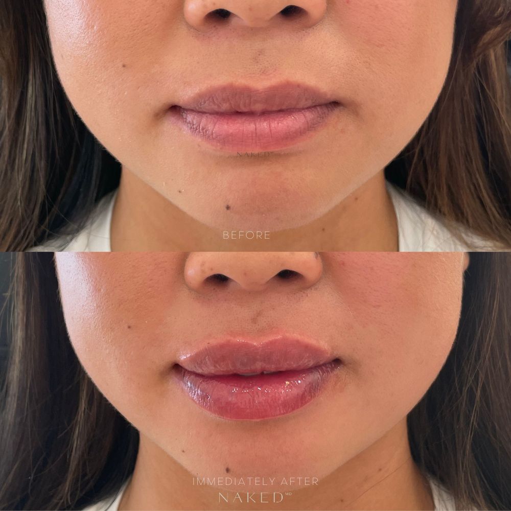Lip Filler | Lip Injections to Improve Your Smile – NAKEDMD Medspa